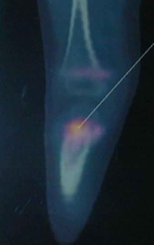 Sarcoma de Ewing da tíbia - Oncocirurgia